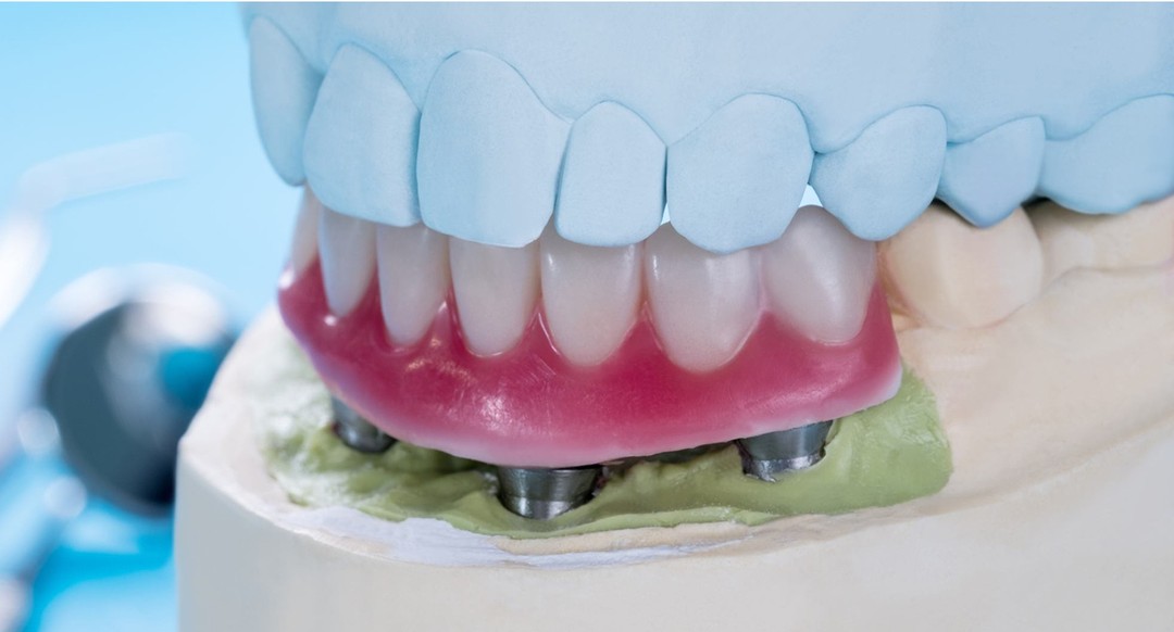 Custom Dentures in Maitland, FL | Pacha & Bijan Dental